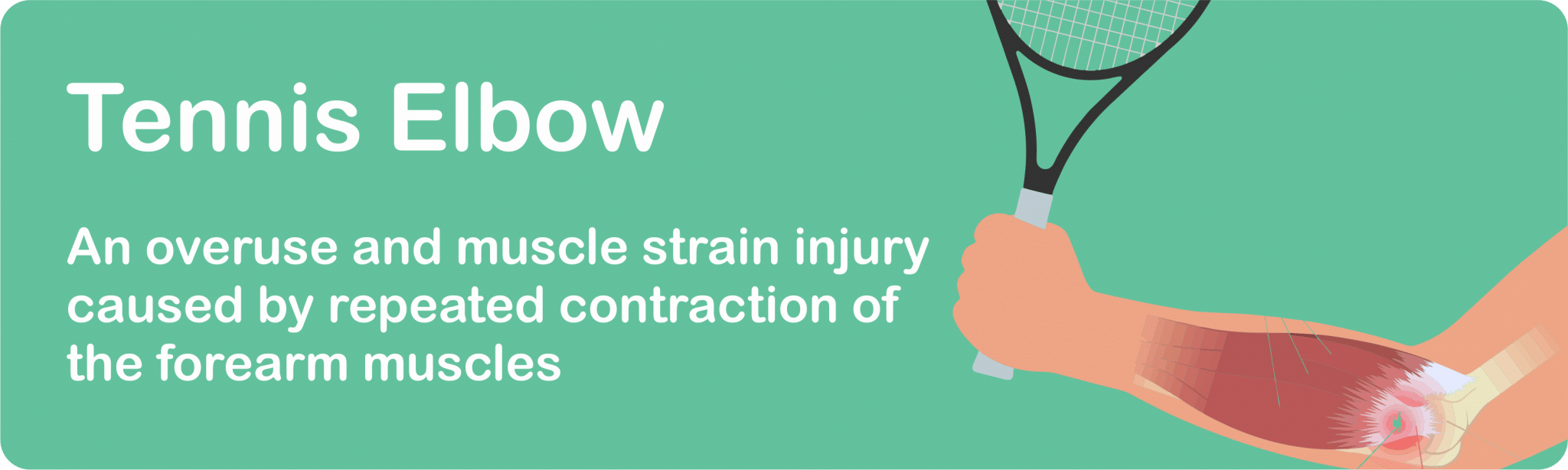 Tennis Elbow (Lateral Epicondylitis) - General Practitioners Ringwood ...